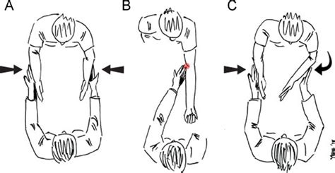 The “hierarchical” Scratch Collapse Test For Identifying Multilevel Ulnar Nerve Compression Pmc