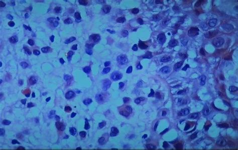 Polymorphous Inflammatory Infiltration And Infiltrate Of Langerhans Polymorphous Inflammatory Infiltration And Infiltrate Of Langerhans