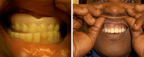 Male Dentures Images Smiles Better