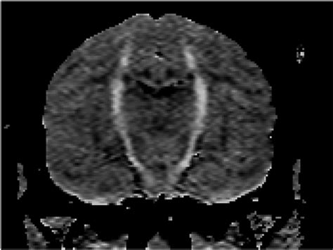 The First Diffusion Tensor Imaging Case This Image Is Primarily The Download Scientific