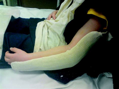 Rapid Splintage Of Acute Long Bone Fractures The Annals Of The Royal College Of Surgeons Of