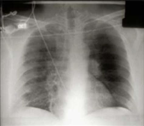 Clinical Medicine I Understanding Pulmonary Embolism Flashcards Quizlet