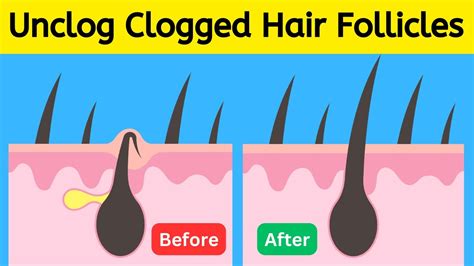 6 Expert Tips To Unclog And Prevent Blocked Hair Follicles How To