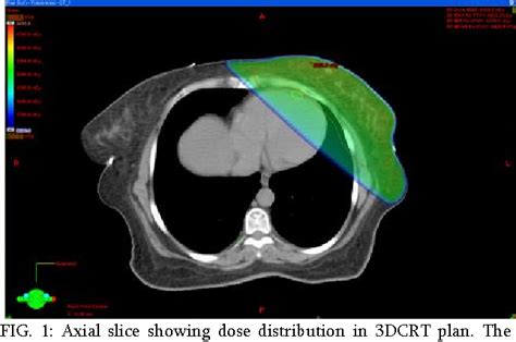 Imrt Breast Cancer All About Radiation