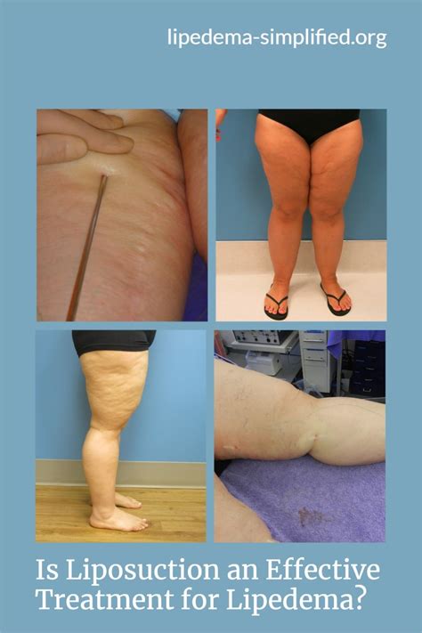 Patient 48369542 Lipedema Before After Photos David Amron Md Artofit