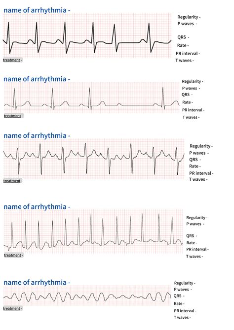 ECG Basics All Types Of Ecg Arrhythmias Every Nurse And Nursing Babe Should Know For Life Or