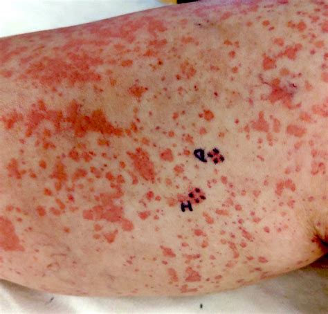 Clinical Research Dermed Laser Education