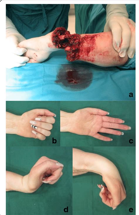 Case Two Subtotal Amputation Of The Forearm A Preoperative Picture