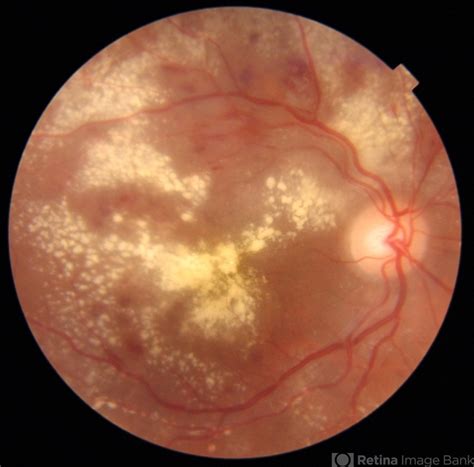 Severe Exudative Diabetic Retinopathy Right Eye Retina Image Bank
