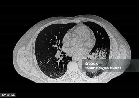 폐 종양을 가진 남성 환자의 Cat 스캔 Mri 스캔에 대한 스톡 사진 및 기타 이미지 Mri 스캔 폐암 전이성 종양