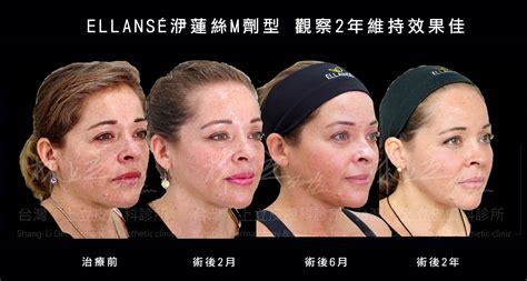 撫平法令紋，洢蓮絲可以維持多久？