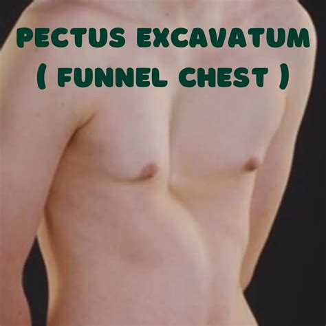 Pectus Excavatum 7 Shocking Facts You Must Know
