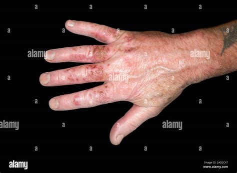 Chemical Burns Close Up Of Chemical Burns On The Hand Of A 68 Year Old