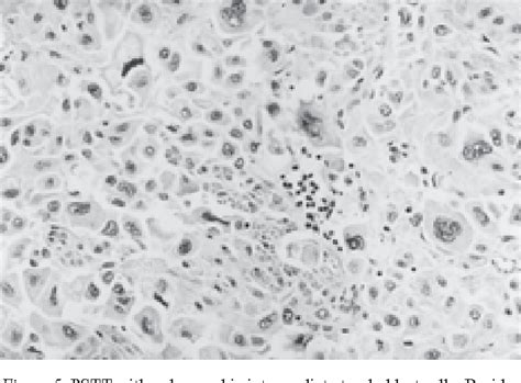 Figure 1 From Placental Site Trophoblastic Tumor Conservative