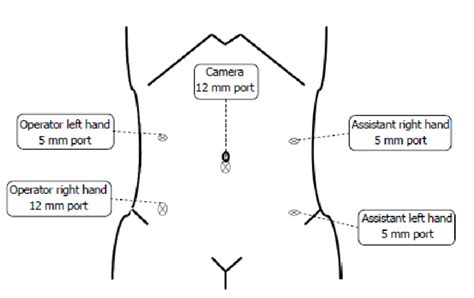 Laparoscopic Port Sites For Left Sided Colectomy And Proctectomy Download Scientific Diagram