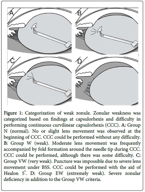 Categorization And Surgical Techniques Of Weak Zonule Based On Fi