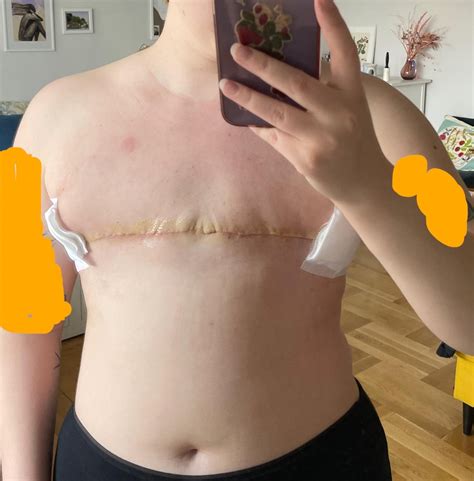 18 Days Post Op Di No Nips R Topsurgery
