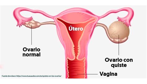 Quistes de Ovario Síntomas y Tratamientos Dr Lucas Minig Valencia