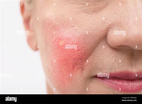Woman With Rosacea On White Background Closeup Problem Skin Treatment