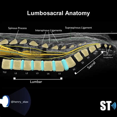 Neonatalinfant Spine Sonographic Tendencies Ultrasonido Radiología
