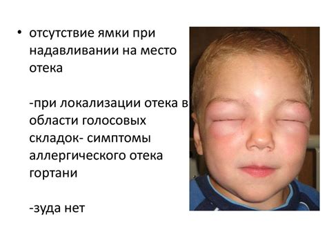 Отек Квинке Крапивница Неотложная помощь презентация онлайн