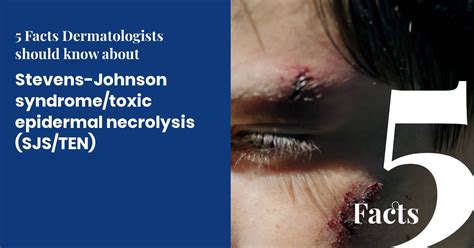 Stevens Johnson Syndrometoxic Epidermal Necrolysis Sjsten Rare