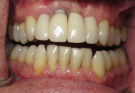 The Best Types Of Dental Implants And Techniques