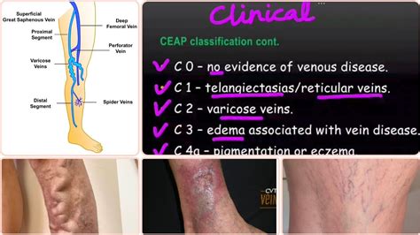 Ceap Classification Of Venous Ulcers General Surgery Knowing