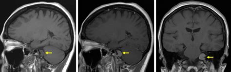 Cpa Meningioma Radiology Cases