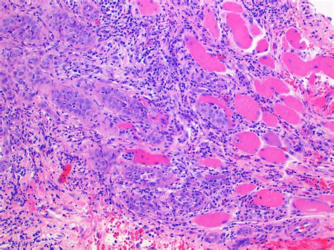 Histologic Image Of Oral Squamous Cell Carcinoma Hematoxylineosin