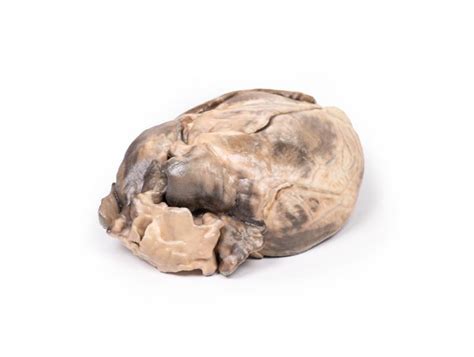 Hypertrophic Subaortic Stenosis Australian Physiotherapy Equipment