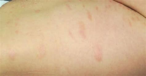 Seborrheic Pemphigus Causes Symptoms Photos Of Rashes Diagnosis Treatment And Advice From