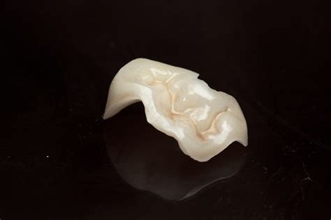 Inlay And Overlay Natural Dental Lab