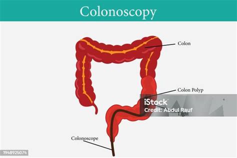 Colonoscopy Stock Illustration Download Image Now Colorectal Cancer