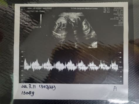 일란성 쌍둥이 시험관 성공 후 임신기록 30주 강남차병원 태동검사 정밀초음파 관악구 산후도우미 예약 네이버 블로그