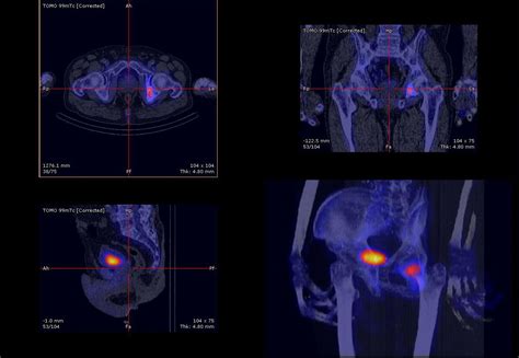 What Is A Spect Ct Scan Used For Ct Scan Machine