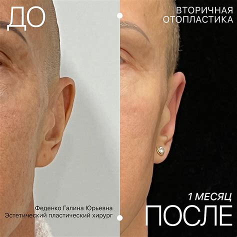 Отопластика в Санкт-Петербурге | Цена на операцию по исправлению ...