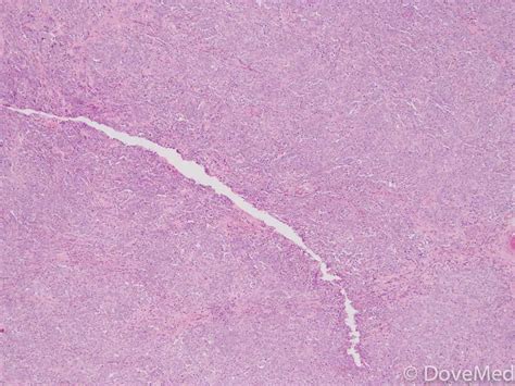 Ovarian Dysgerminoma Dovemed