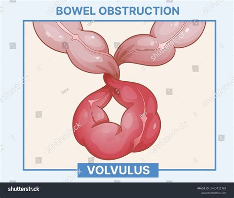 Twisted Loop Intestine Over 17 Royalty Free Licensable Stock