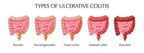 Infografía De Tipos De Colitis Ulcerosa 6245139 Vector En Vecteezy