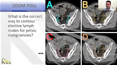Contouring Pelvis Session 2 Pelvic Nodal Contouring Youtube