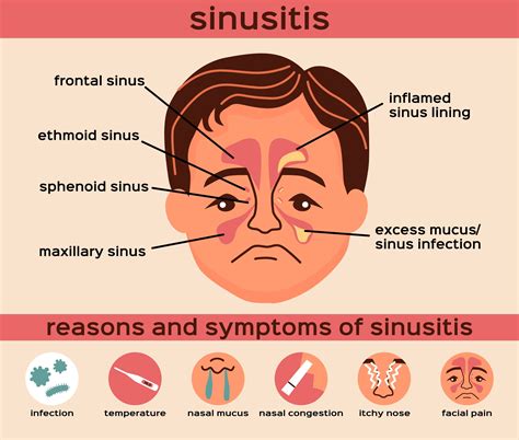 Sinusitis Treatment In Los Angeles Causes Symptoms And Solutions