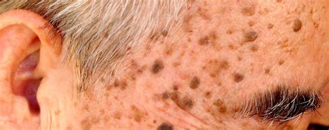Benign Tongue Lesions