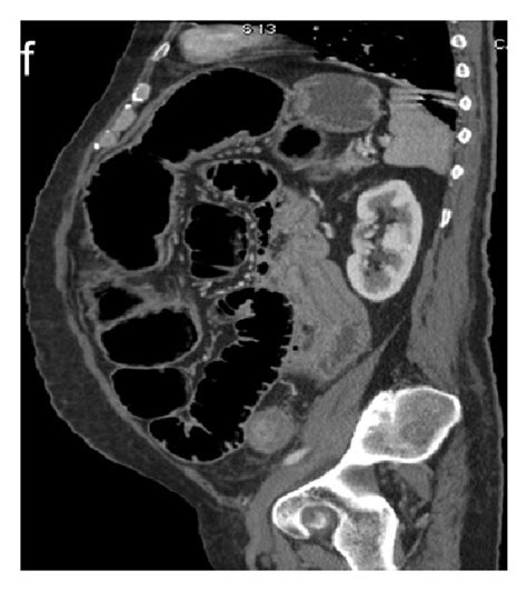 Enteroenteric Ileoileal Intussusception Secondary To Colic