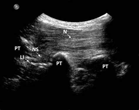 Us Guided Nerve Root Infiltration On The Level Of L2 L3 Us