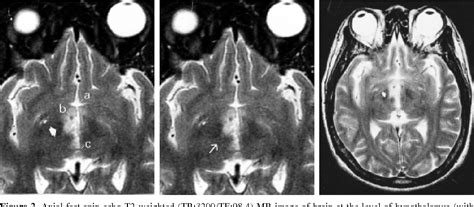 Figure 2 From Hyperhidrosis Probably Due To Hypothalamic Involvement In