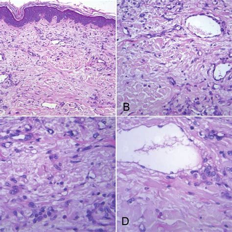 Histology Of A Biopsy From The Angiosarcoma A Poorly Circumscribed