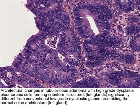 Pathology Outlines Tubulovillous Villous Adenoma
