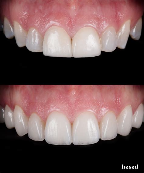 Composite Veneers Vs Porcelain Veneers Which One Is Better