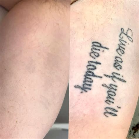 What Can Remove Tattoo Ink